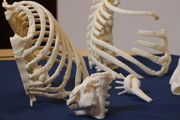 3D printing can aid surgery for multiple rib fractures - Health Data ...