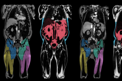 Siemens Healthineers, AMRA partner on body analysis tool - Health Data ...