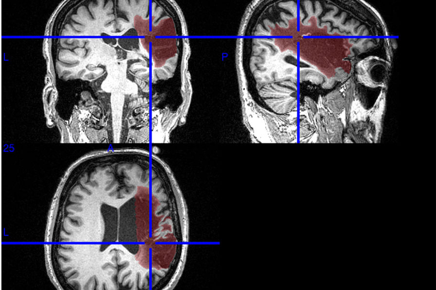 Brain MRI images can predict cognitive function after heart attack ...