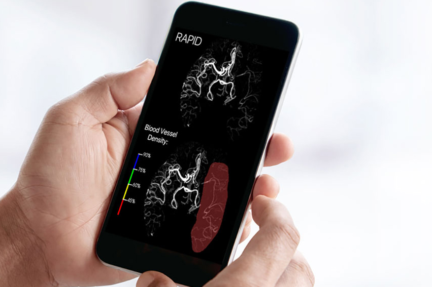 FDA clears device that enables 3D mapping of vessels in brain - Health ...