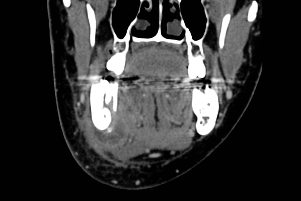 CT is overused in diagnosing dental infections in ERs - Health Data ...