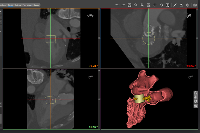 Software enables accurate 3D planning for cardiac procedures - Health ...