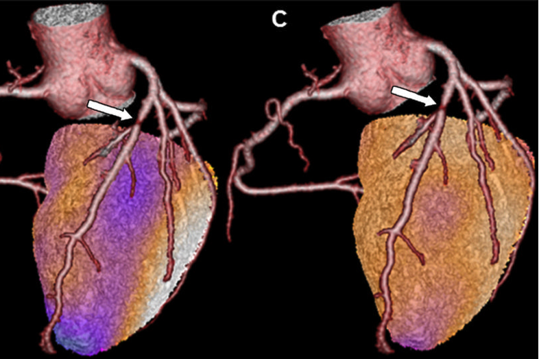 Hybrid heart imaging can foresee major cardiac events - Health Data ...
