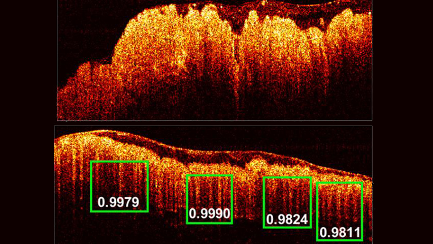 Deep learning identifies colorectal cancer tumors with 100 percent ...