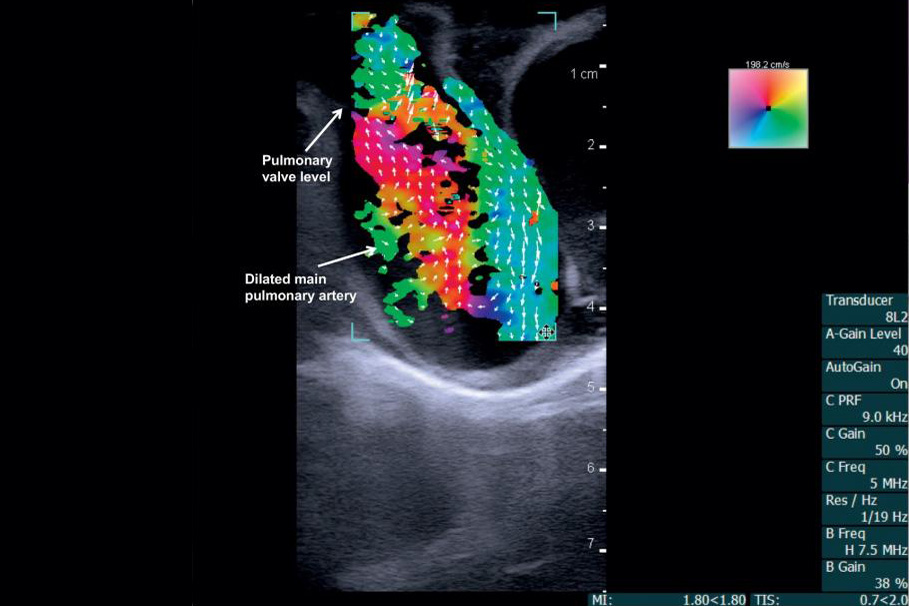 Imaging helps diagnose pediatric congenital heart disease - Health Data ...